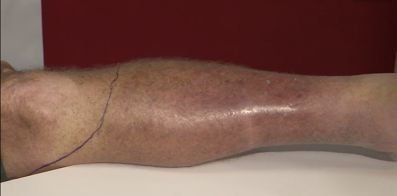 Be Careful Where You Wade: Florida Angler’s Leg Infected from Polluted ...